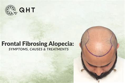 Frontal Fibrosing Alopecia Symptoms Causes And Treatment Options