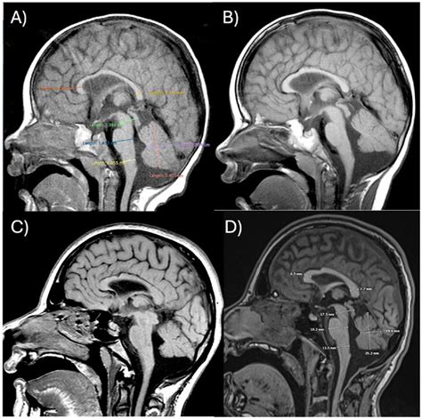 Neuroanatomical Features Of Naa10 And Naa15 Related Neurodevelopmental Syndromes Pmc