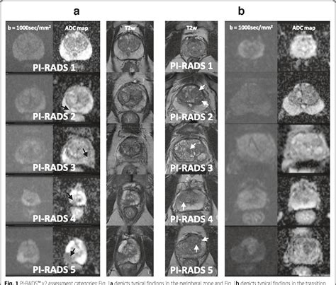 Pi Rads классификация мрт