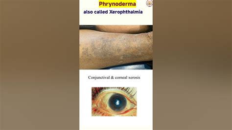 Vitamin A Deficiency Phrynoderma Cause Symptoms And Treatment Skin