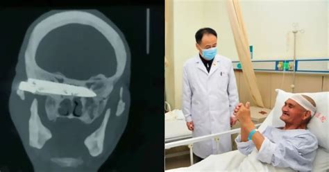 26 Years After He Was Stabbed Doctor Removes Rusty Knife From Chinese