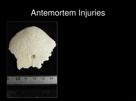 Ppt Discovering Forensic Anthropology Defining Analyzing And Unraveling Human Remains