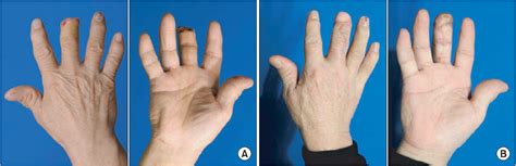 Figure 3 From Free Flap Coverage Of The Finger Defect Caused By Digital