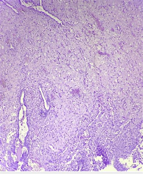 Decidualized Endometrium 10× Section Shows Inactive Endometrial Download Scientific Diagram