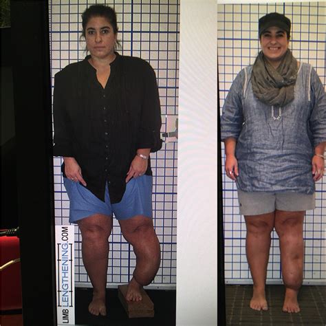 Bowleg Before And After Photos Limb Lengthening