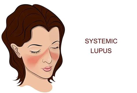 What Besides Lupus Can Cause A Butterfly Rash Other Causes