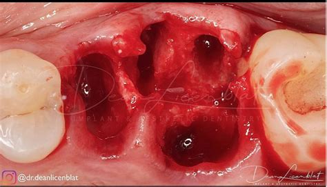 Atraumatic Extractions By Tooth Sectioning Morning Huddle