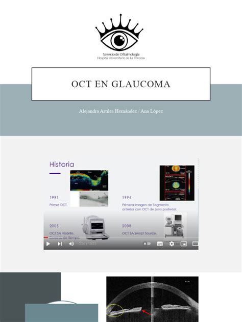 Oct En Glaucoma Pdf