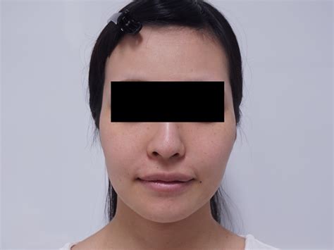 こめかみと頬のコケた感じの部分に10ccのヒアルロン酸 シンシア総院長ブログ～sincerely Yours 銀座の美容外科・美容皮膚科