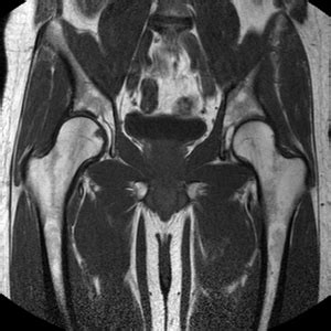 Coronal MRI Hip