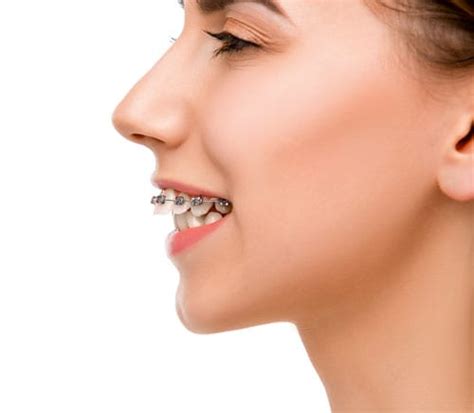What Is An Overbite And How Is It Corrected Orthodontics In Toronto