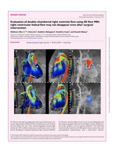 Pdf Evaluation Of Double Chambered Right Ventricle Flow Using 4d Flow