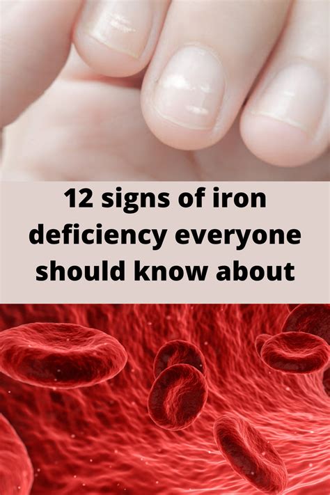 Symptoms Of Iron Deficiency Pre And Op Pinterest Iron