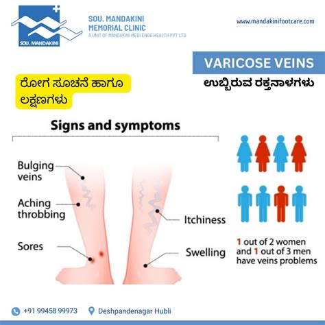 Varicose Veins Signs And Symptoms Mandakini Foot Care