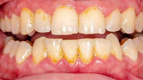 How To Remove Tartar From Teeth Without Dentist HACKS