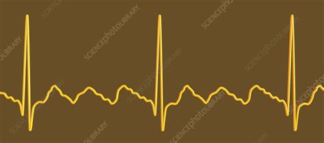 Atrial Flutter Abnormal Heartbeat Rhythm Illustration Stock Image