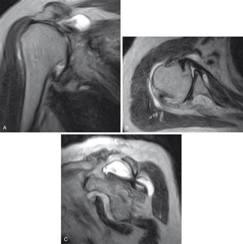 Rotator Cuff Arthropathy What Is It Clinical Tree