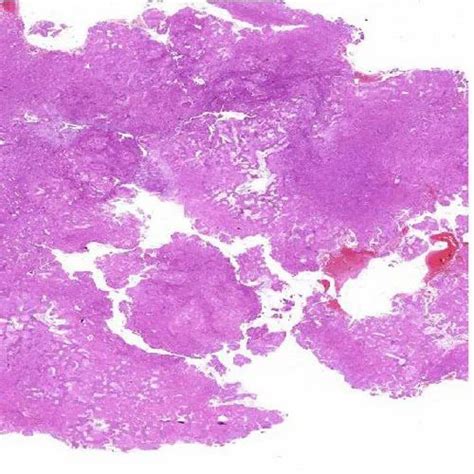 Oral Pathology Fibrous Dysplasia At Rs 800piece Noida Id 7806647830