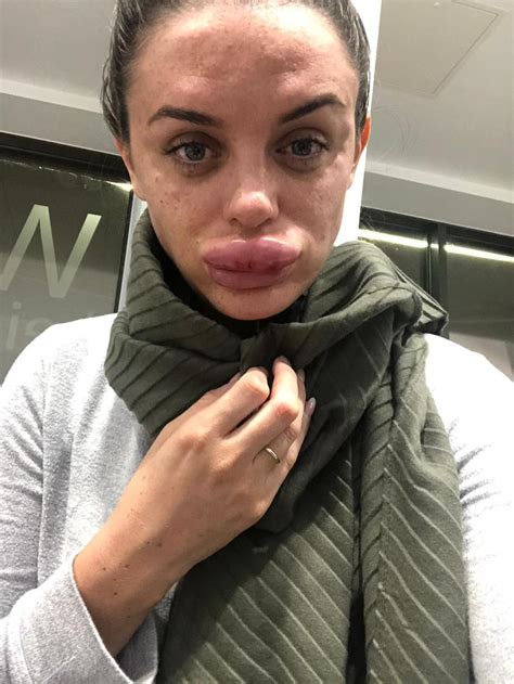 Botox Gone Wrong Botox Forehead Eyebrow Lift Botox Bo