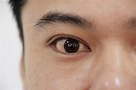 武汉大学中南医院眼科陈中山医生眼睛充血是怎么回事