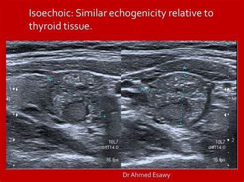 Tirads Thyroid Nodule Imaging Reporting And Data System Dr Ahmed E…