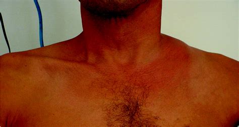 Swollen Supraclavicular Lymph Nodes