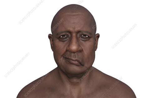 Left Side Stroke Illustration Stock Image F0436034 Science