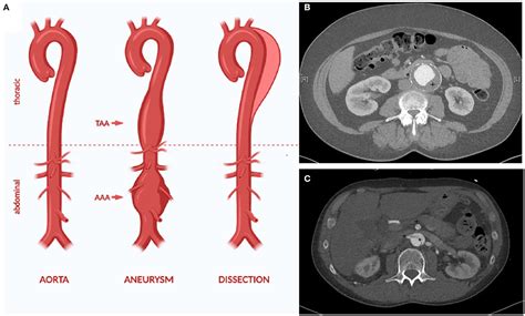 8 Best Aortic Dissection Images Aortic Aneurysm Aorti