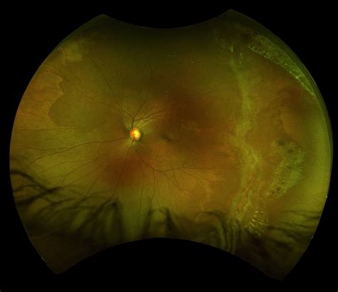 Myopia With Lattice Degeneration And White Without Pressure In The