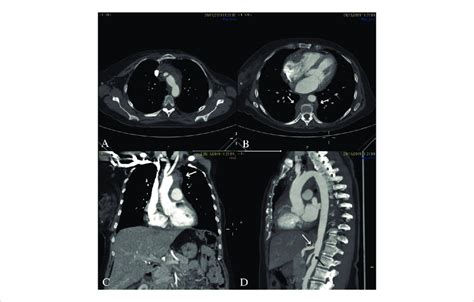 Cect Janela Mediastinal A C Plano Axial Mostra Massa De Atenuação Download Scientific
