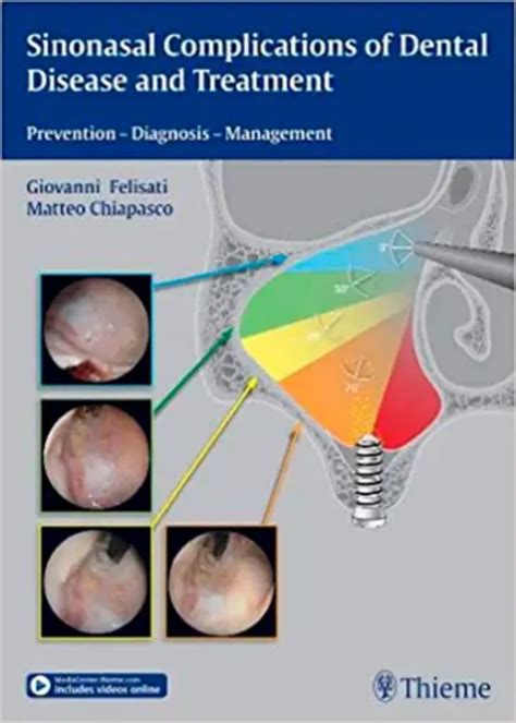 Livro Sinonasal Complications Of Dental Disease And Treatment