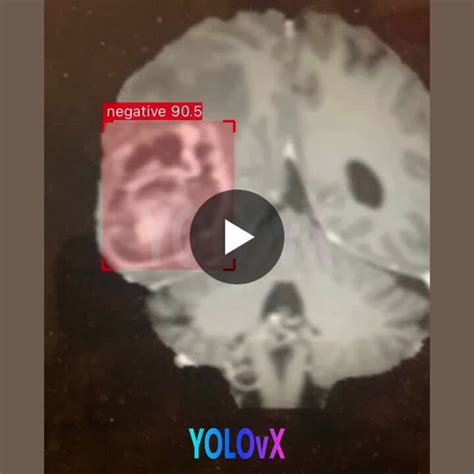 Yolovx Ai For Brain Tumor Detection Yolovx Posted On The Topic Linkedin