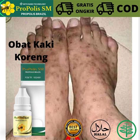 Jual Obat Penghilang Bekas Koreng Obat Koreng Penghilang Koreng Di Kaki Obat Herbal