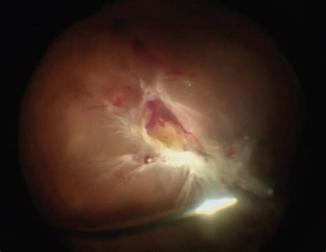 Bimanual Vitrectomy And Membrane Peeling For Tractional Retinal
