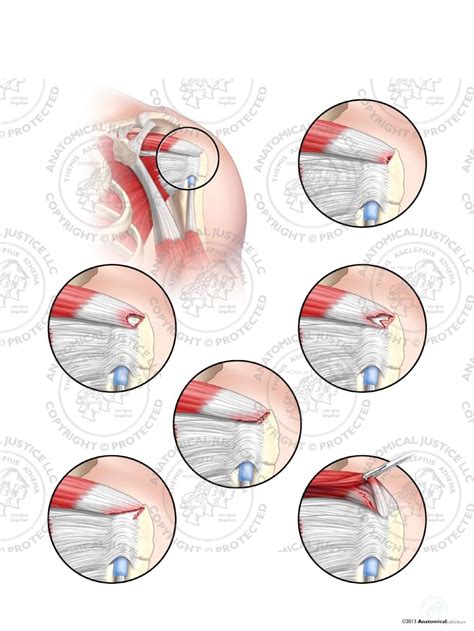 Left Rotator Cuff Tear Variations No Text