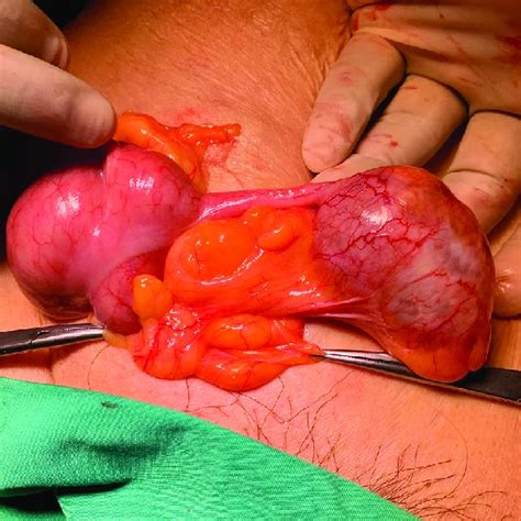 The Appendix Is Lined By Columnar Epithelium With Apical Mucin And Download Scientific Diagram