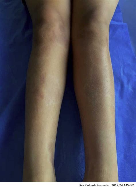 Juvenile Localized Scleroderma Is It A Benign Disease Revista Colombiana De Reumatología
