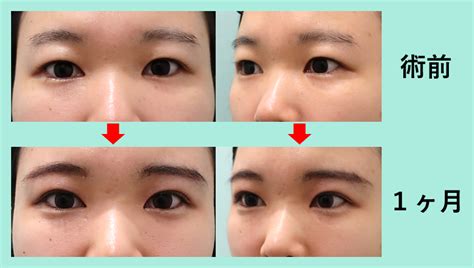 重たい瞼をスッキリさせる【 眉毛下皮膚切除＋roof脂肪切除 】 東京・銀座の美容外科クリニック｜wom Clinic Ginza