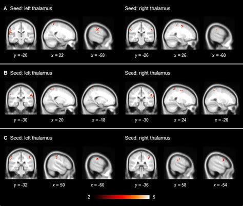 Significant Increase In Thalamic Functional Connectivity In Adult