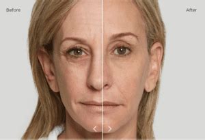 Fotos Antes E Depois Liftera Coolfase Bioestimulador Profhilo