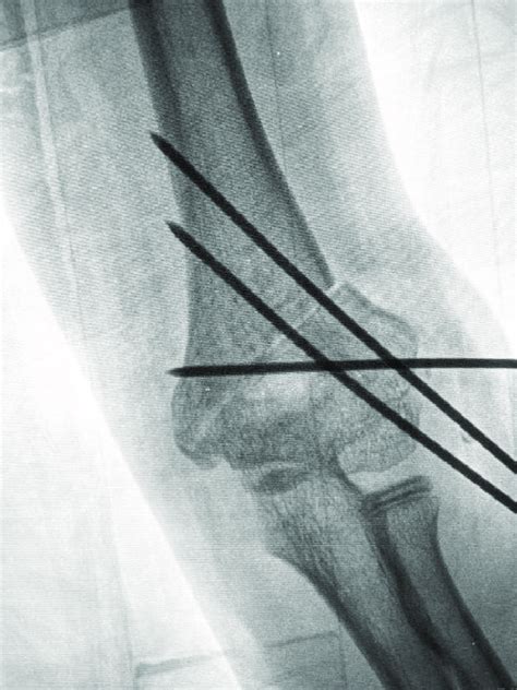 Osteotomy Was Performed Parallel To The Preoperatively Marked Proximal