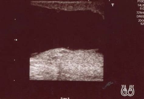 Scrotal Ultrasonography Image Showing Liquid Component Neoplastic