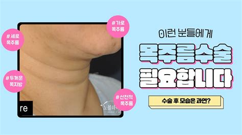 목주름성형 수술 왜 압구정 노블와이성형외과에서 많이할까 ★더보기란 필독★ Youtube