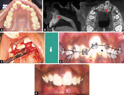 Supernumerary Teeth Extraction