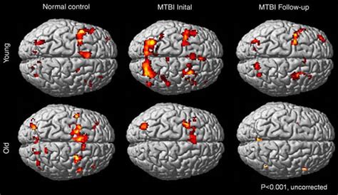 Older Patients Recover More Slowly From Concussions Neuroscience News