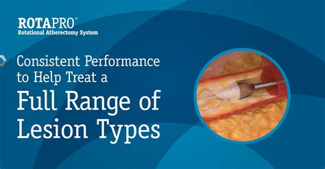 Boston Scientific Cardiology On Linkedin Rotapro™ Rotational