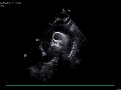 Basics Of Echo Cardiac Structure Chamber Quantifications And Artifactspptx