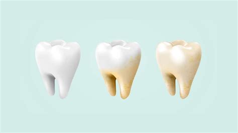 Tooth Discoloration 101 Aurora Dental Group
