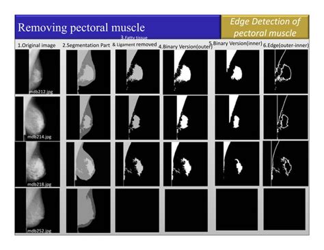 Microcalcification Identification In Digital Mammogram For Early