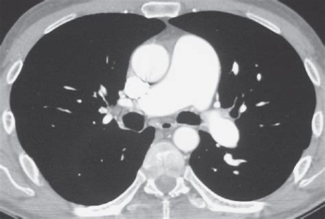 Pulmonary Vasculature Disease Radiology Key